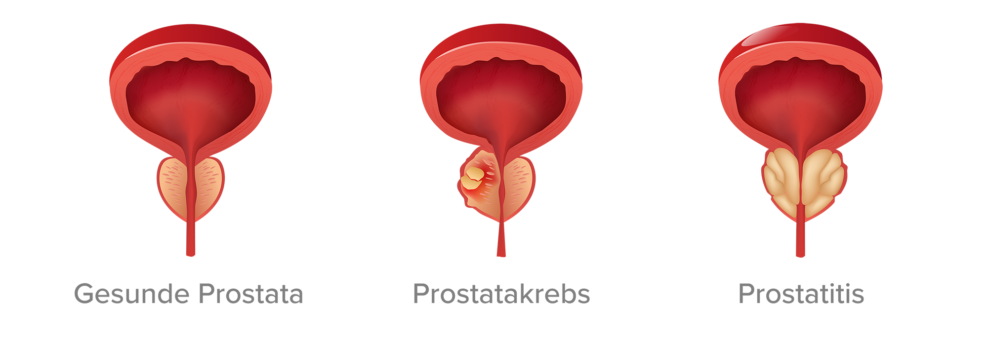 Prostatauntersuchung - Urologe Wien - Dr. Bernhard Neuwirth